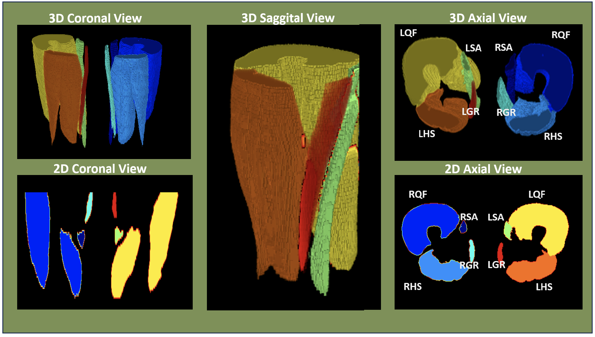 Multi Method And Multi Atlas Segmentation Fusion For Delineation Of Thigh Muscle Groups In 3d